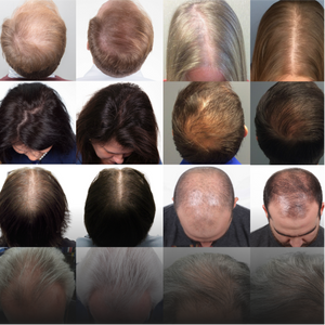 Laser Cap for Hair Growth: Stop the Hair Loss with Capillus Hat - Best ...