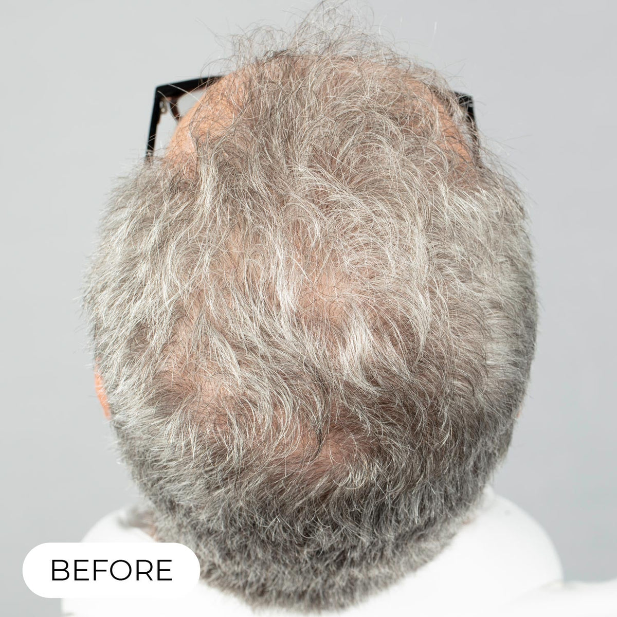 Laser Caps for Hair Growth - Combat the Hair Loss with Capillus Hats