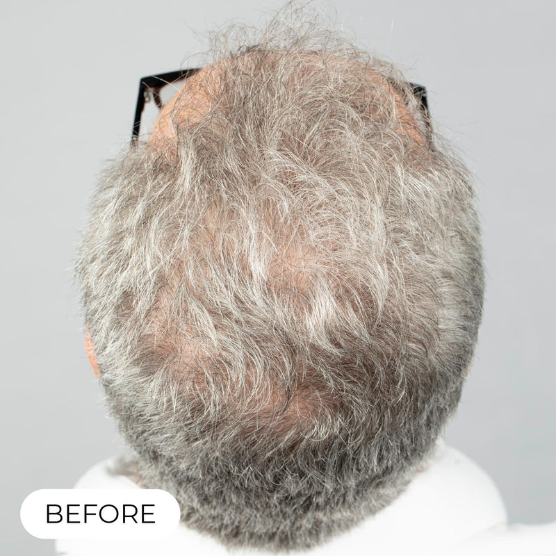 Laser Caps for Hair Growth - Combat the Hair Loss with Capillus Hats