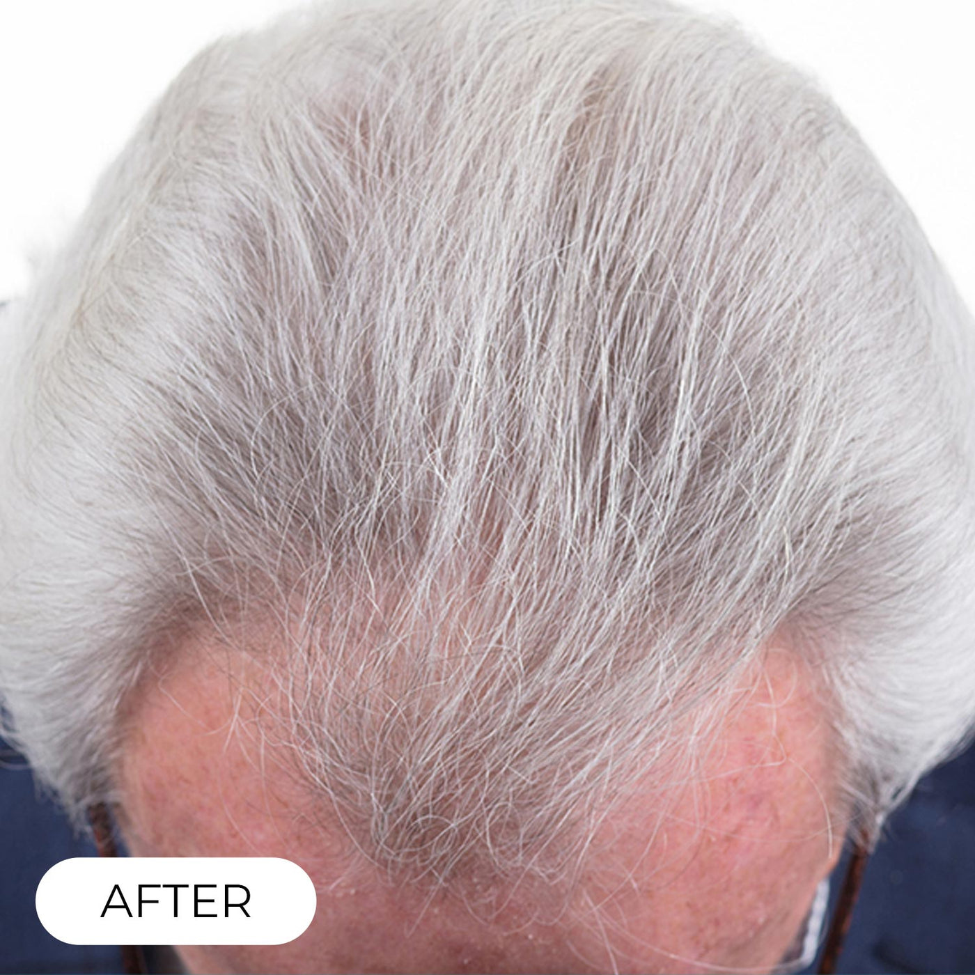 CapillusPro Hair Regrowth Laser Cap