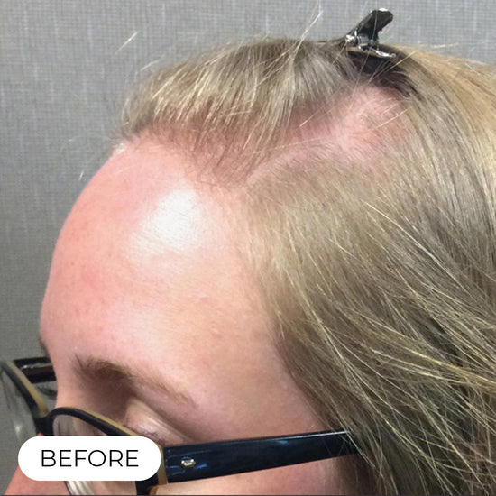 CapillusPro Hair Regrowth Laser Cap