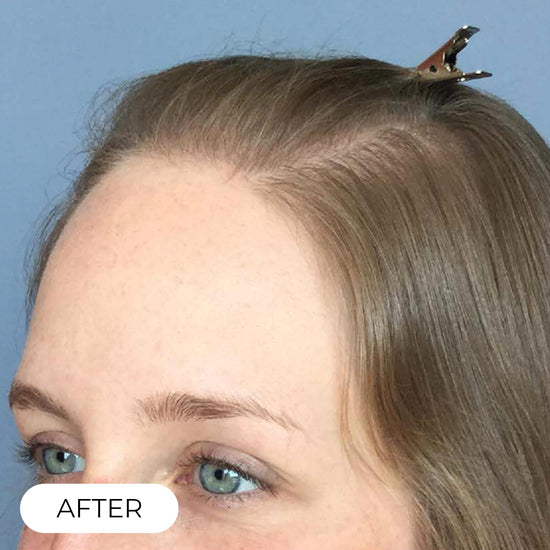 CapillusPro Hair Regrowth Laser Cap