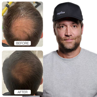 Capillus Pro S2 Laser Cap for Hair Growth