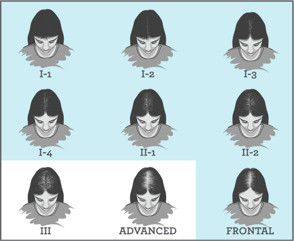 Hair Loss in Women - How Laser Cap for Hair Growth Can Help? | Capillus