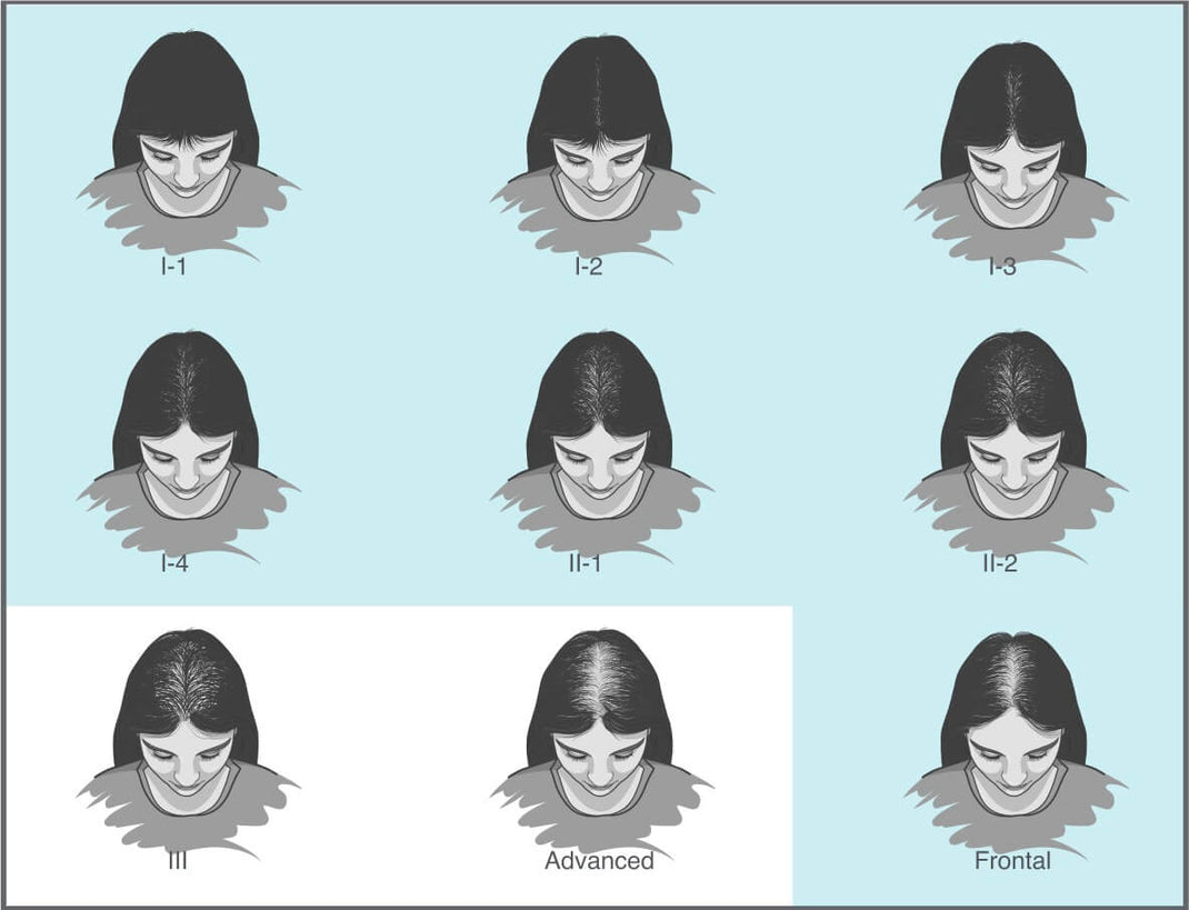 Hair Loss in Women - How Laser Cap for Hair Growth Can Help? | Capillus