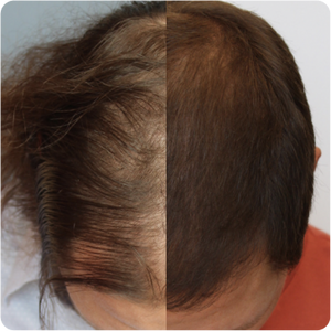 CapillusPro Hair Regrowth Laser Cap