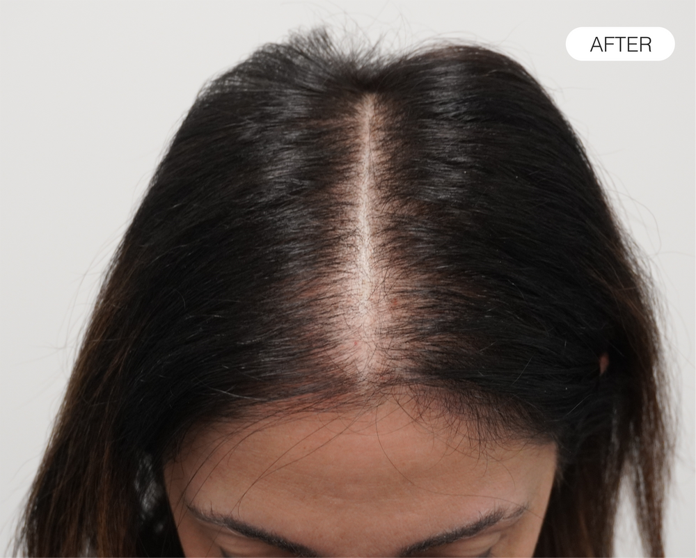 Hair Loss in Women - How Laser Cap for Hair Growth Can Help? | Capillus