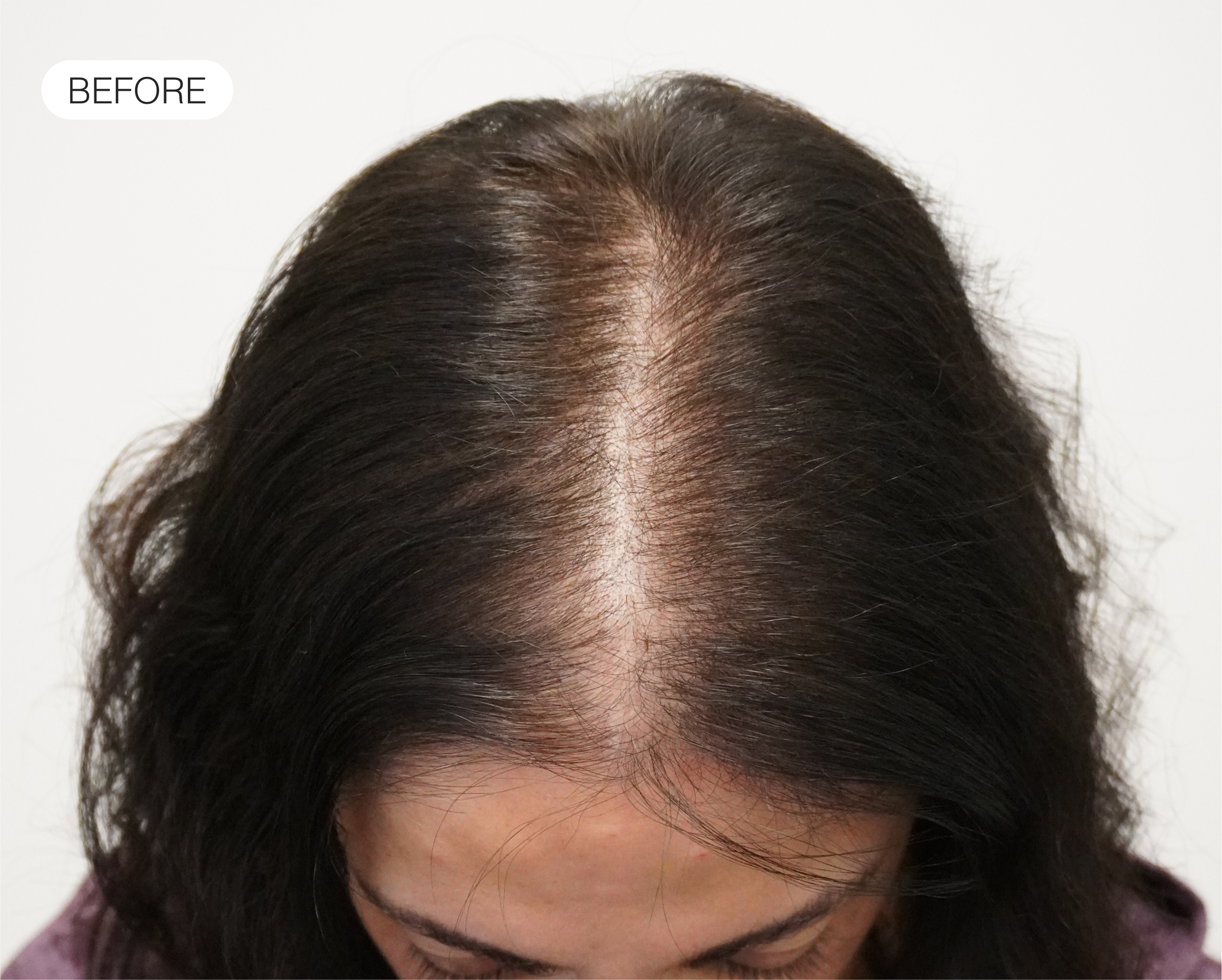Hair Loss in Women - How Laser Cap for Hair Growth Can Help? | Capillus